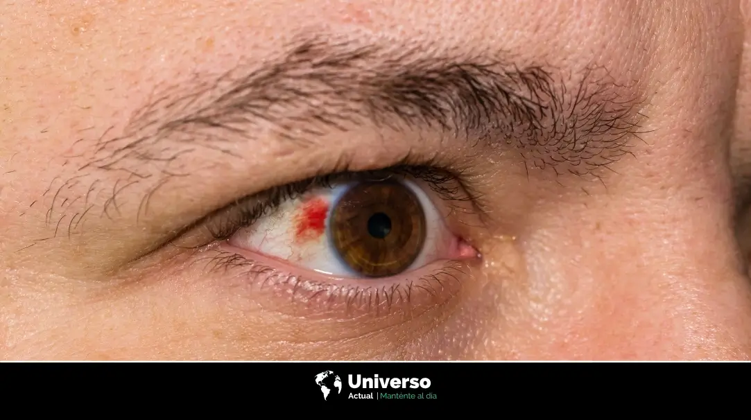 El impactante efecto de los derrames en el ojo por estrés | Universo Actual