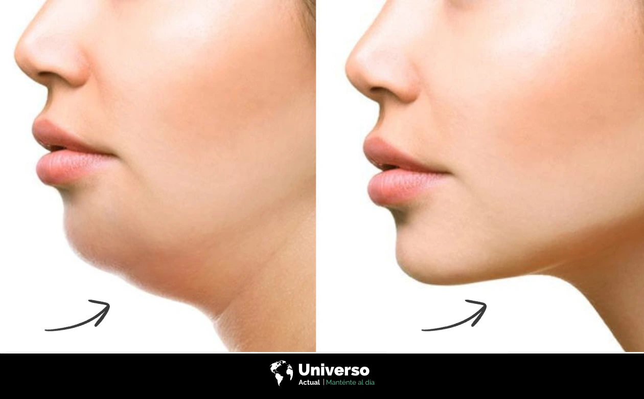 ¿Qué es el Mewing?: Beneficios, riesgos y consideraciones | Universo Actual